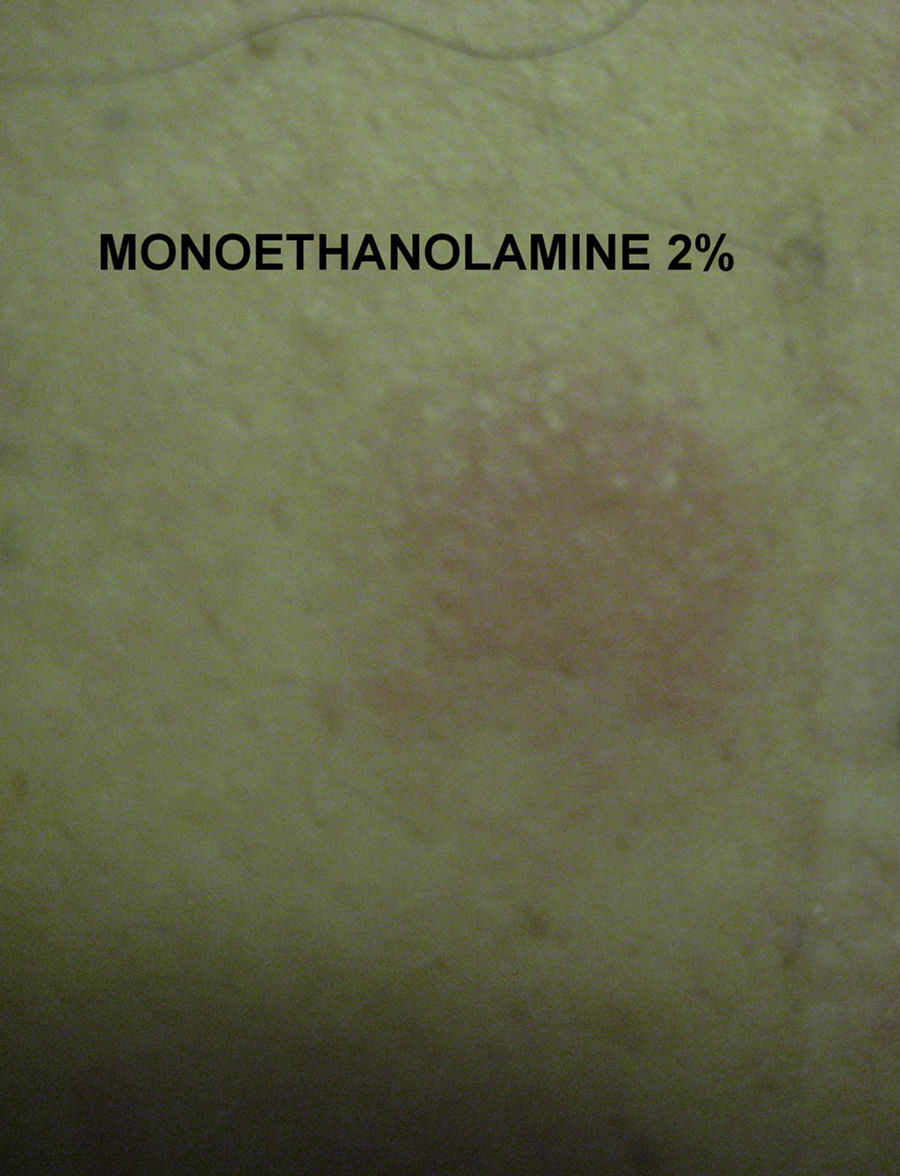 Occupational allergic contact dermatitis from monoethanolamine in a ...