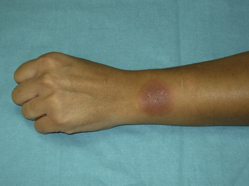 Fixed drug eruption due to norfloxacin and cross-reactivity with other ...