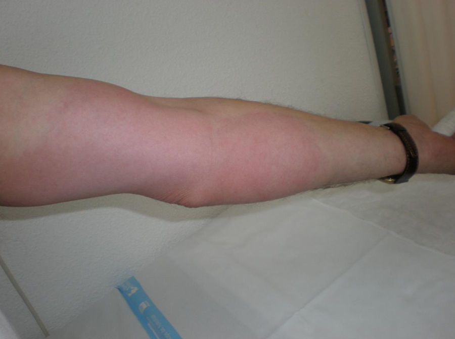 Successful treatment of severe delayed pressure angio-oedema with ...