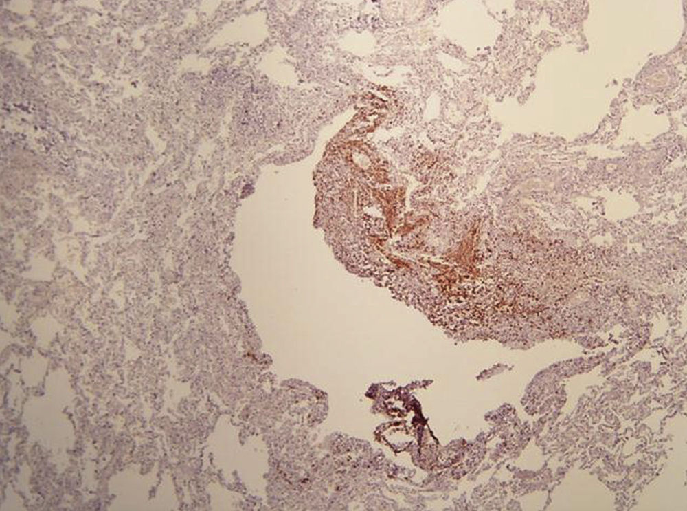 Adolescent form of sporadic lymphangioleiomyomatosis (S-LAM ...