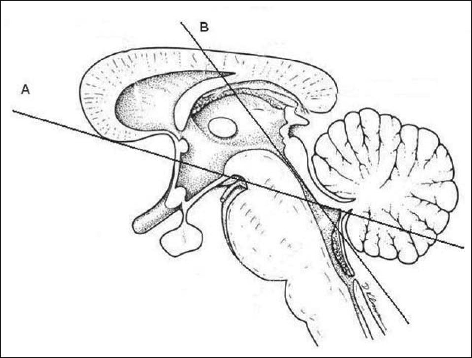 variante dandy walker