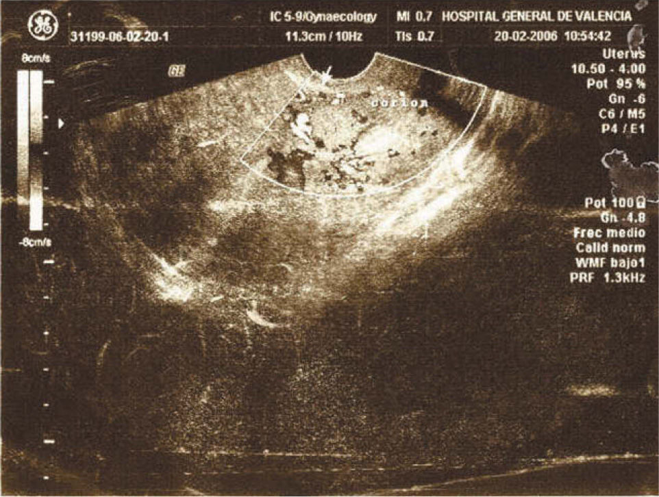 Embarazo ectópico cervical: diagnóstico y tratamiento | Progresos de ...
