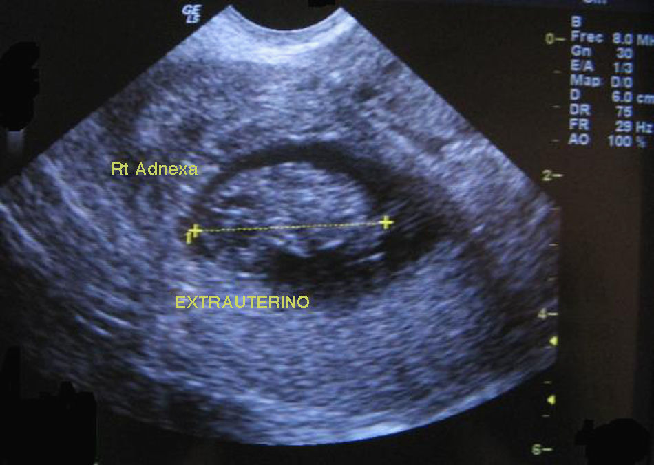 Embarazo ectópico abdominal. Diagnóstico y tratamiento médico con ...