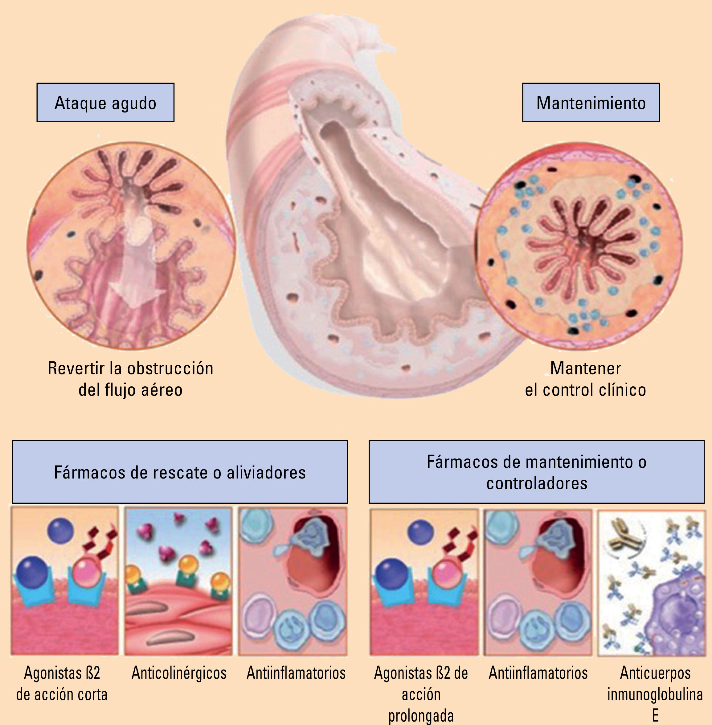 Asma bronquial - Medicine online