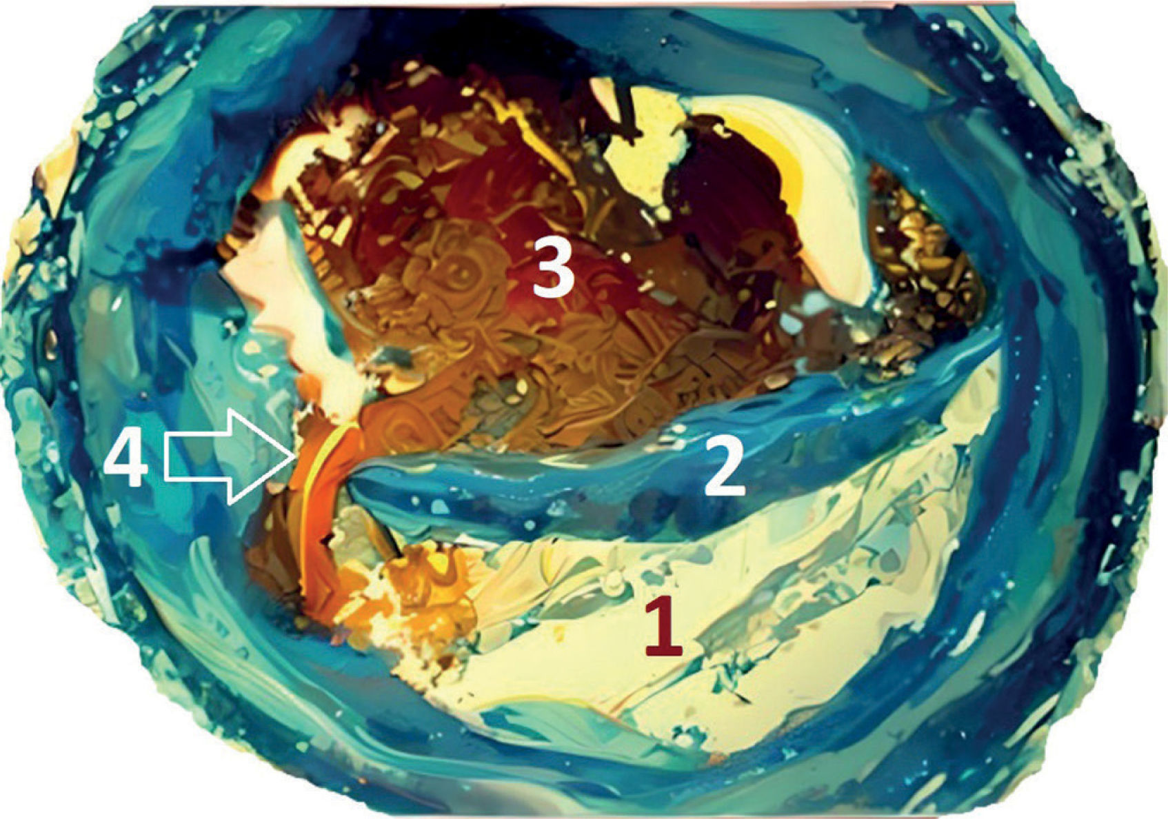 Ateroesclerosis. Etiopatogenia. Placa estable y placa vulnerable ...