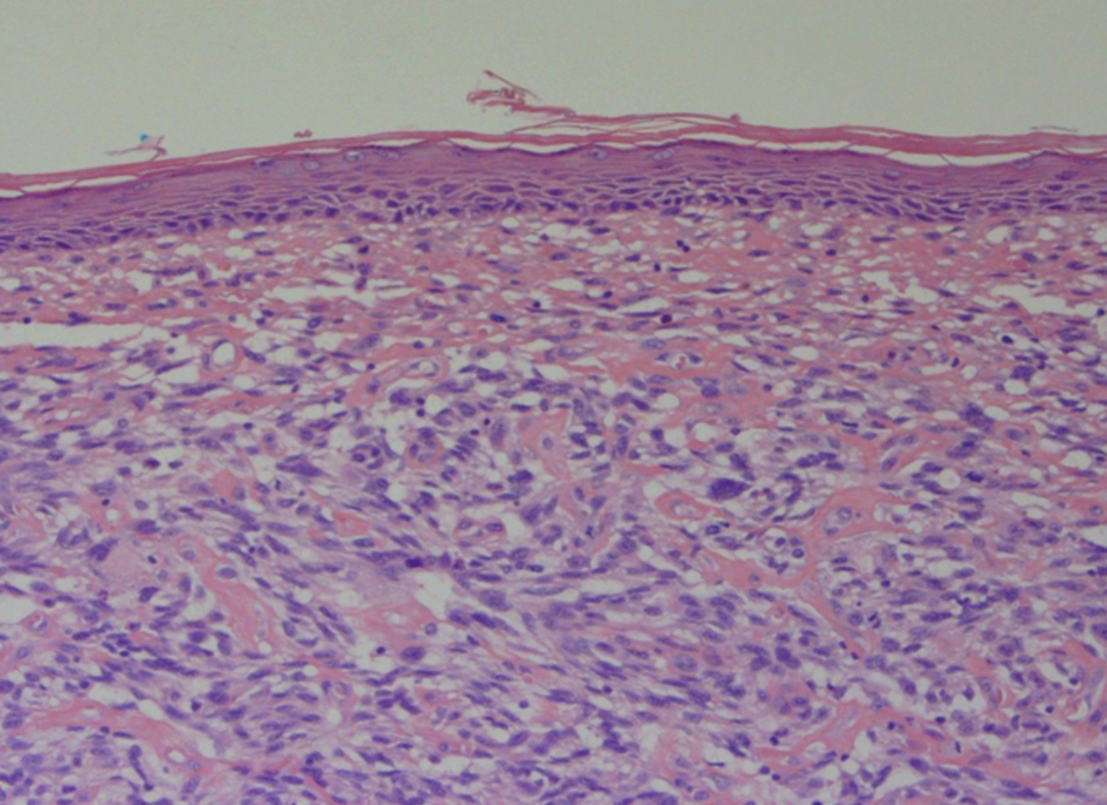 Metastatic pleomorphic dermal sarcoma: an uncommon skin tumour* | Anais ...