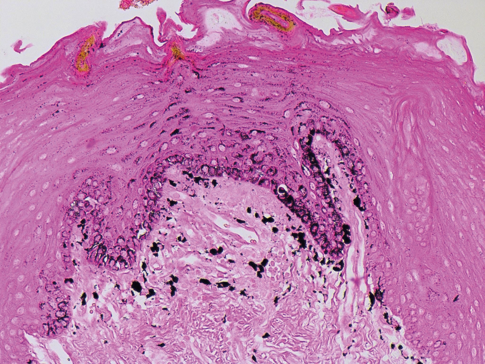 Lingual melanotic macule – the first case report in an adult patient ...