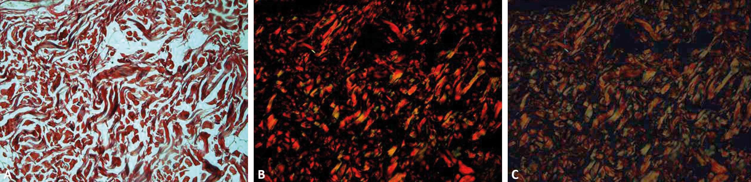 Evaluation of dermal collagen stained with picrosirius red and examined ...