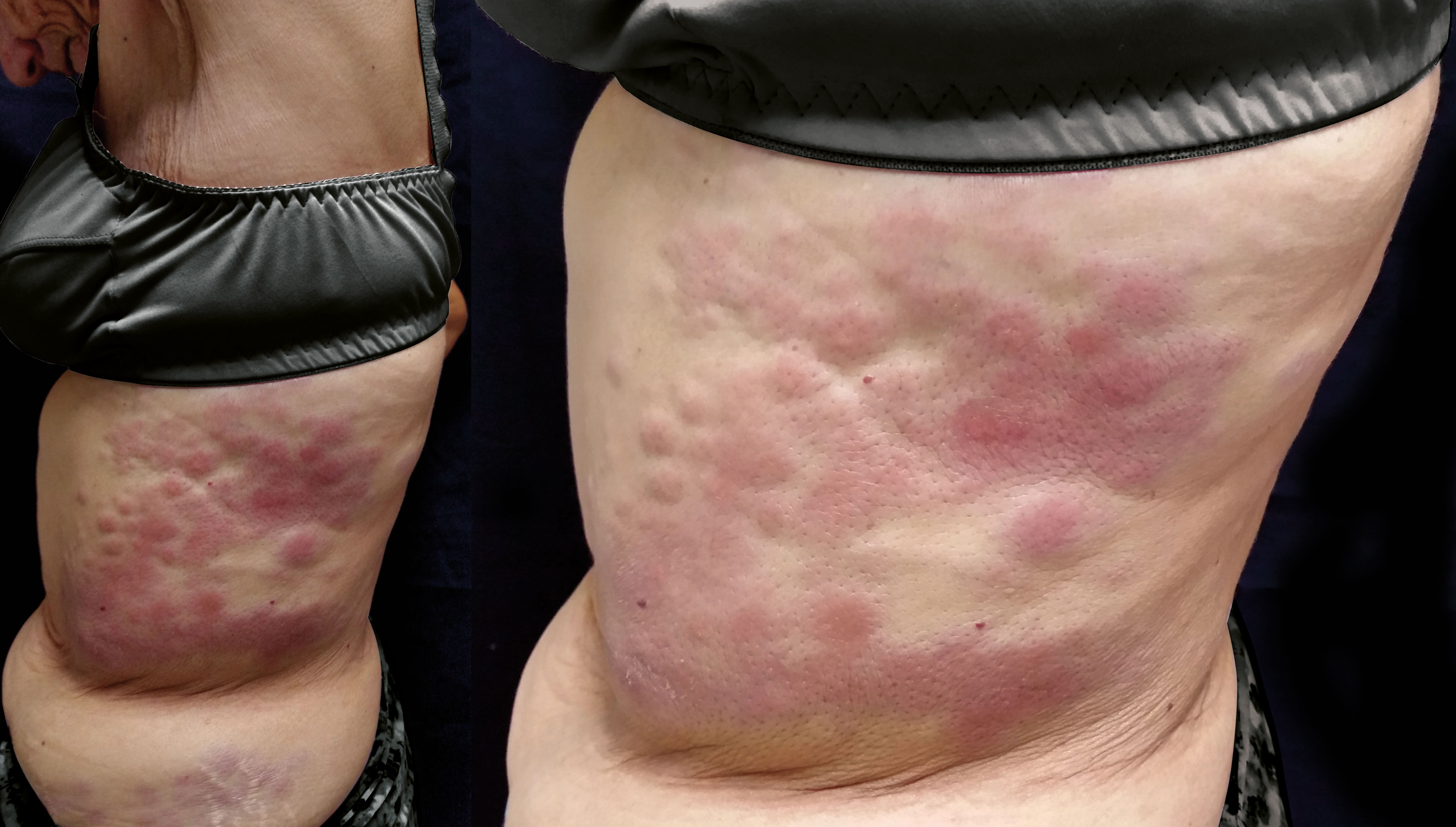 orange peel skin breast cancer photos