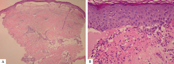 Adult linear IgA bullous dermatosis: report of three cases* | Anais ...