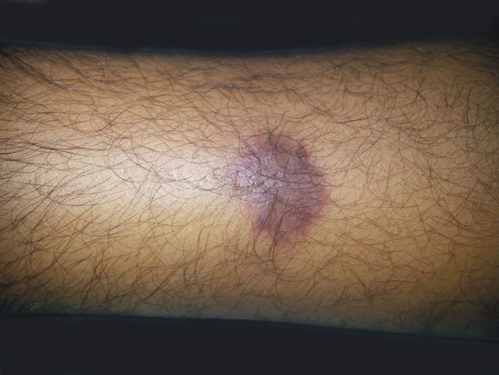 Kaposi’s sarcoma in persons living with HIV/AIDS: a case series in a ...