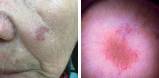 Dermoscopy of granuloma faciale: a description of a new finding ...