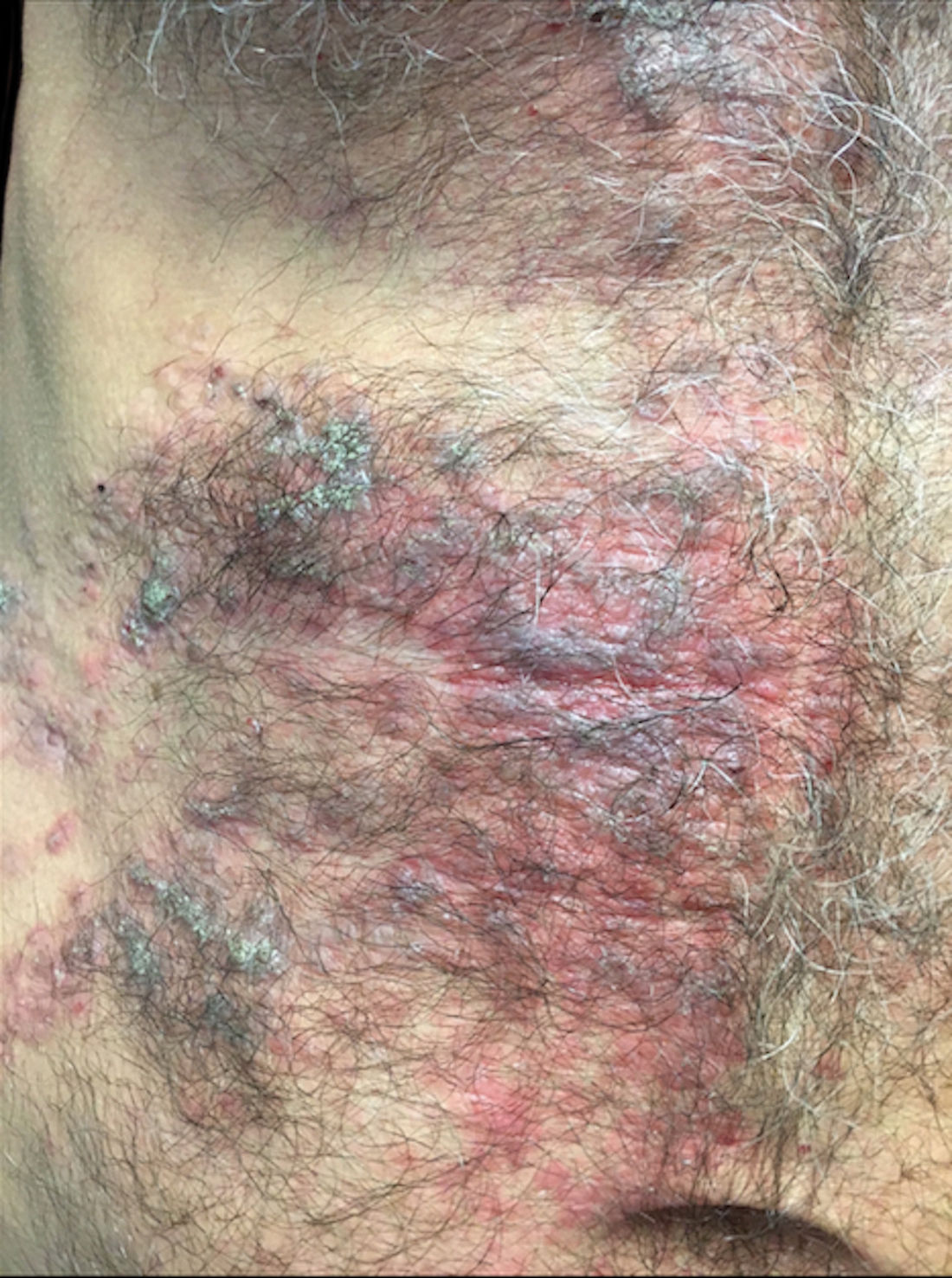 Case for diagnosis. Linear Darier’s disease* | Anais Brasileiros de ...