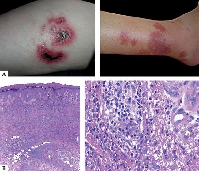 Epstein-Barr virus and skin* | Anais Brasileiros de Dermatologia ...