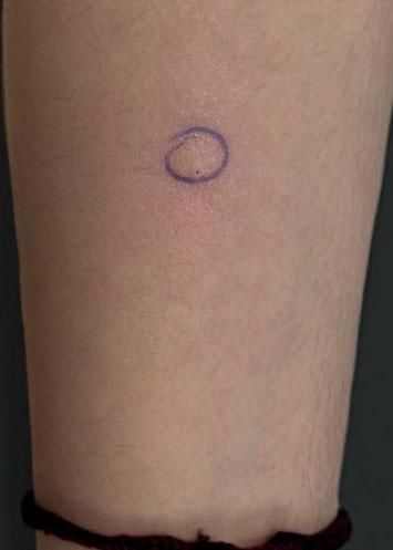 Autoimmune progesterone dermatitis manifesting as generalized fixed ...