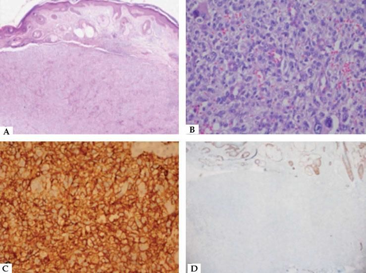 Case for diagnosis. Atypical fibroxanthoma* | Anais Brasileiros de ...