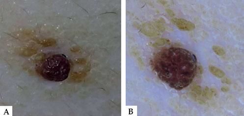Perinevic dermatosis neglecta: clinical and dermoscopic description ...