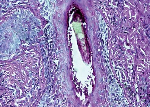 Follicular tinea faciei incognito: the perfect simulator* | Anais ...