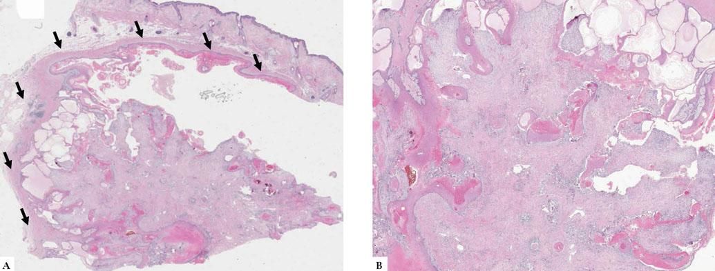 Proliferating trichilemmal cyst with clinical, radiological ...