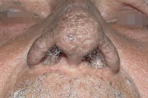 Pemphigus vegetans with isolated involvement of the nose and chest ...