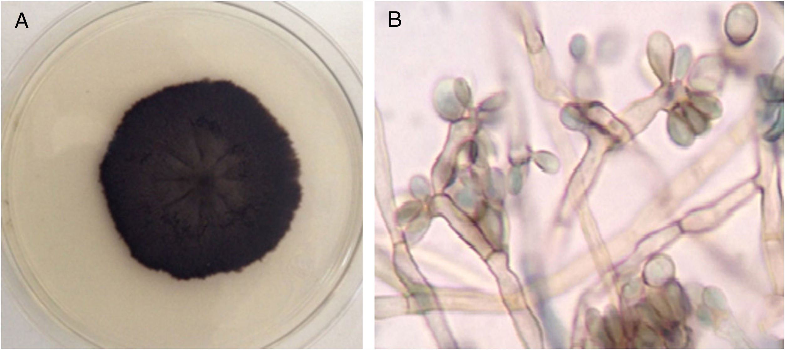 Chromoblastomycosis caused by Rhinocladiella aquaspersa: first case ...