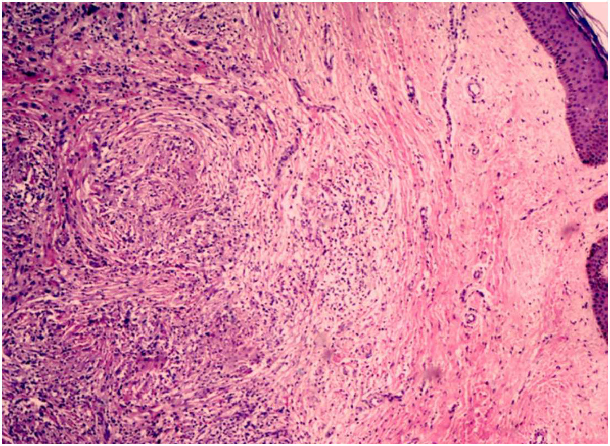 Exuberant case of erythema elevatum diutinum in a patient infected with ...