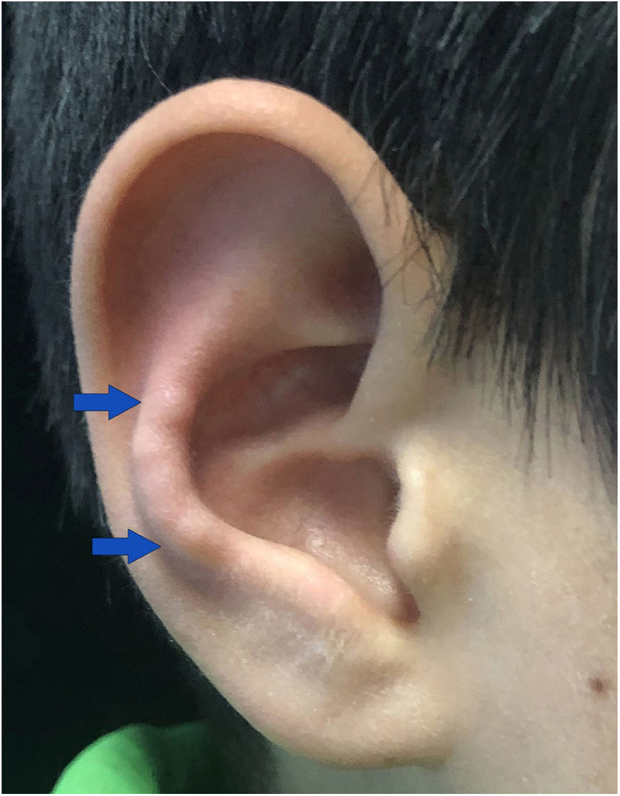 Pediatric chondrodermatitis nodularis chronica helicis | Anais ...