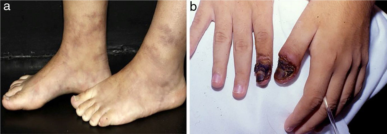 Update on vasculitis: an overview and dermatological clues for clinical ...