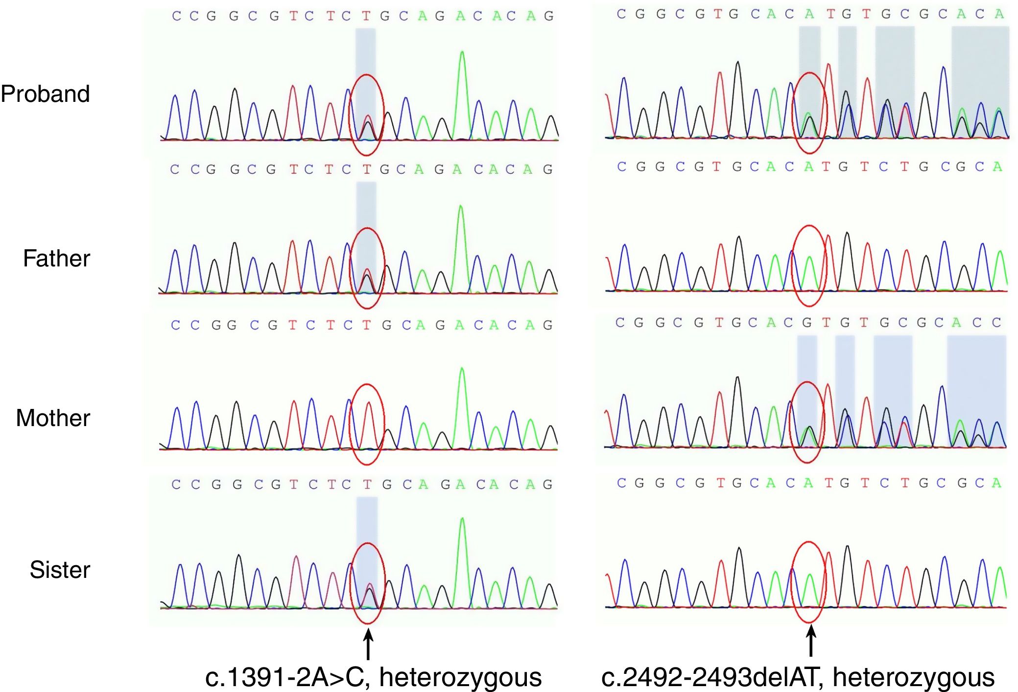 Rare presentation of Rothmund-Thomson syndrome with novel compound ...