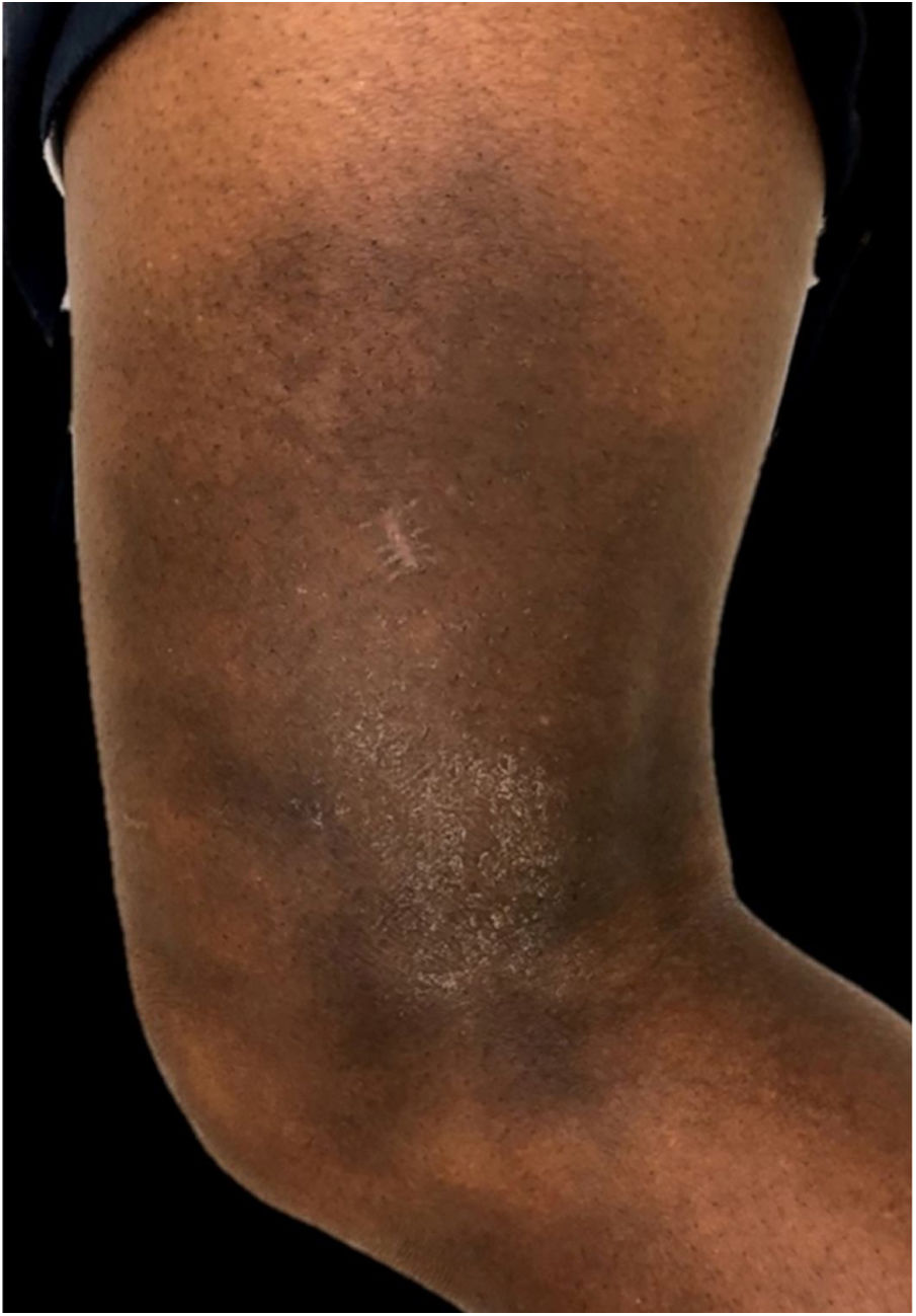 ASIA case after injection of liquid silicone | Anais Brasileiros de ...