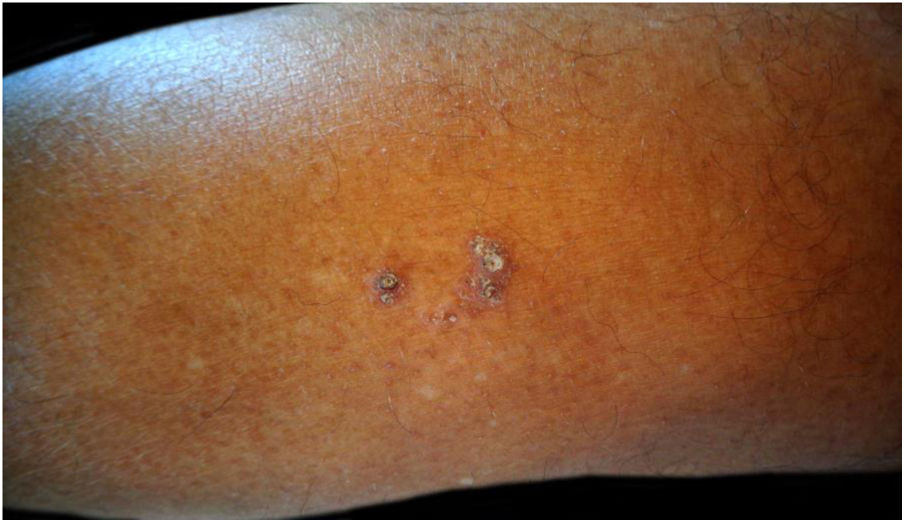 Dermoscopy of late-onset nevus comedonicus | Anais Brasileiros de ...
