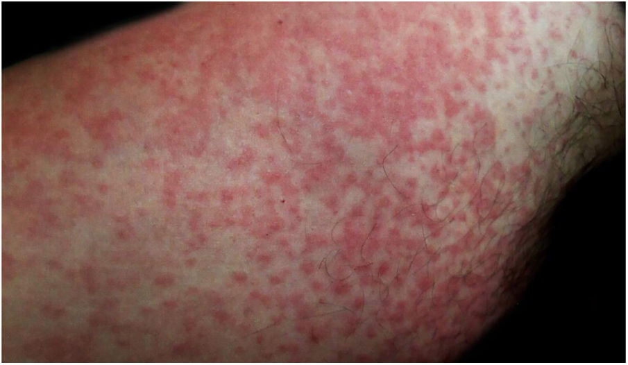 does dengue cause rashes