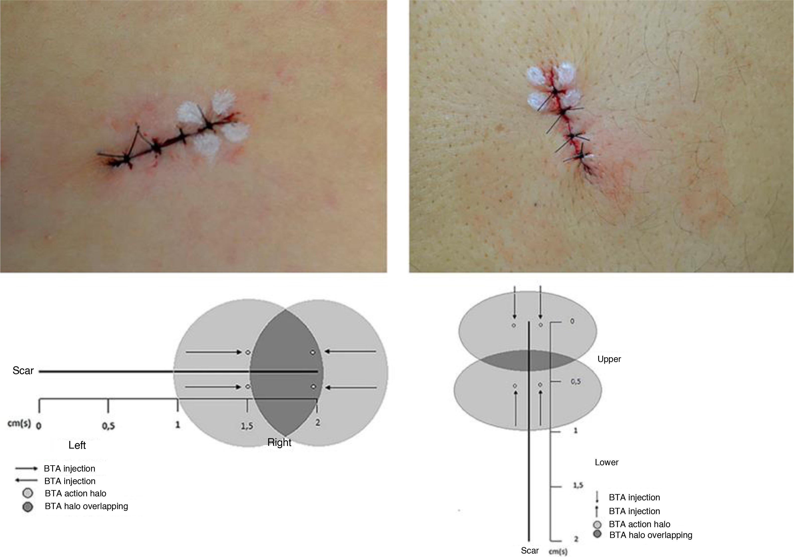 Botulinum toxin-A: evaluation of the influence on the aspect of trunk ...