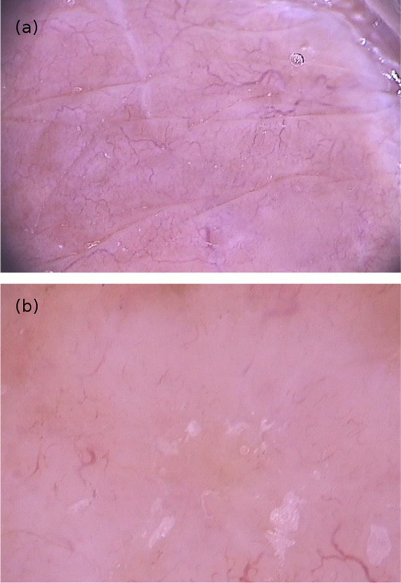Dermoscopy of skin infestations and infections (entomodermoscopy ...