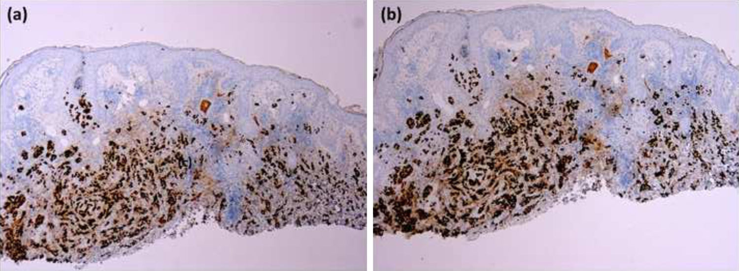 Case for diagnosis. An exophytic plaque on the chest. Carcinoma of the ...