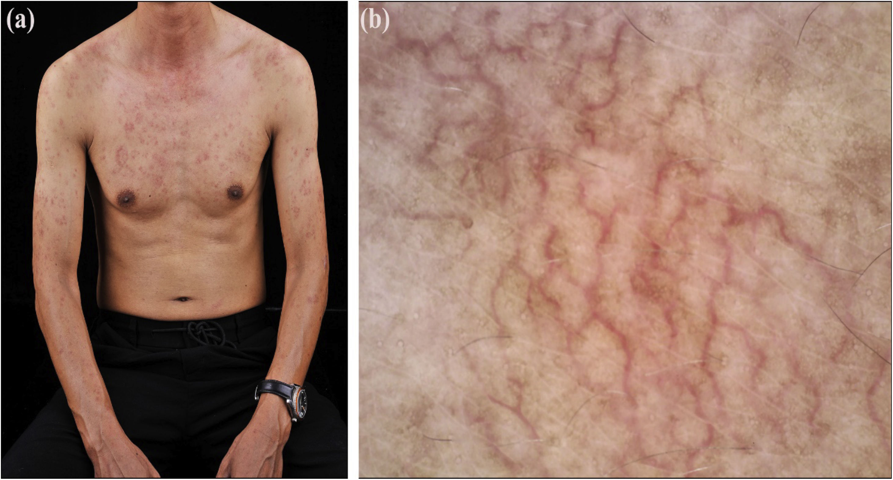 Clinicodermoscopic and immunohistochemical observation of hepatitis B ...