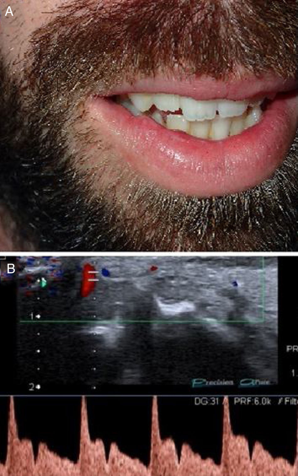 Caliber-persistent labial artery: report of 3 cases | Anais Brasileiros ...