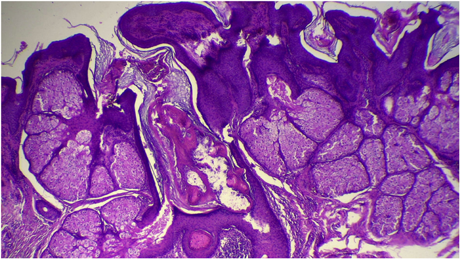 Sebaceous nevus of Jadassohn: review and clinical-surgical approach ...