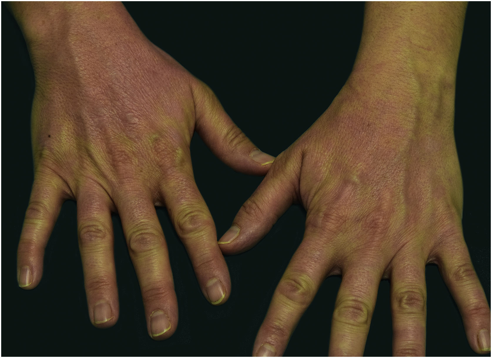 Photosensitive rash induced by nivolumab | Anais Brasileiros de ...