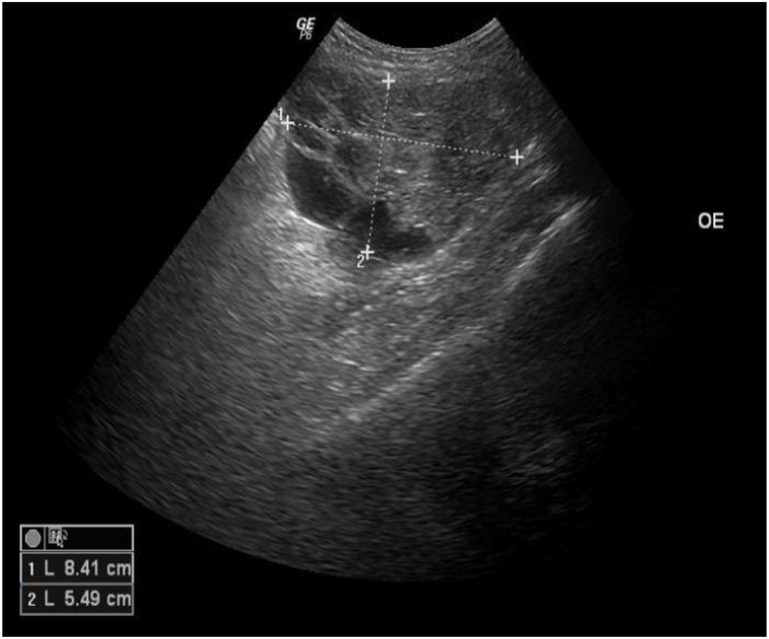 Ovarian carcinoma metastasis manifesting as periumbilical nodules ...