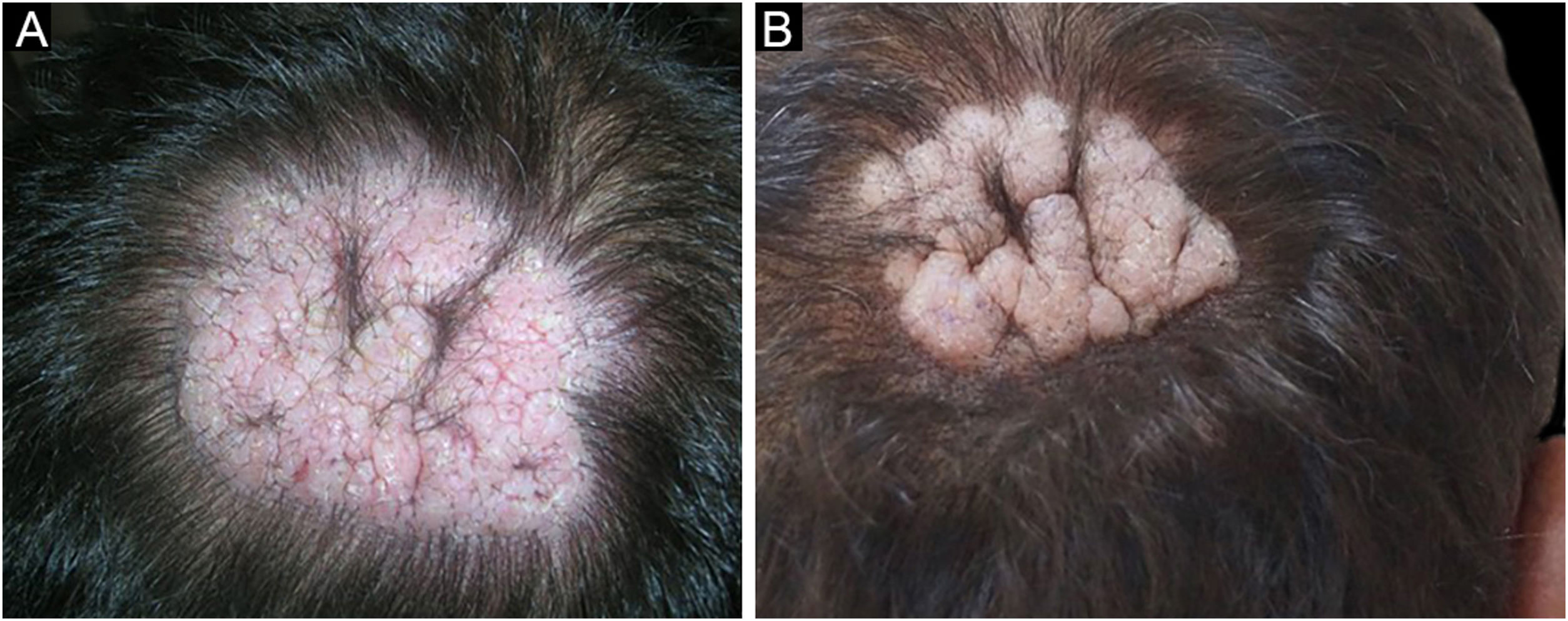 Recalcitrant vegetative and nodular scalp lesions on the vertex in ...
