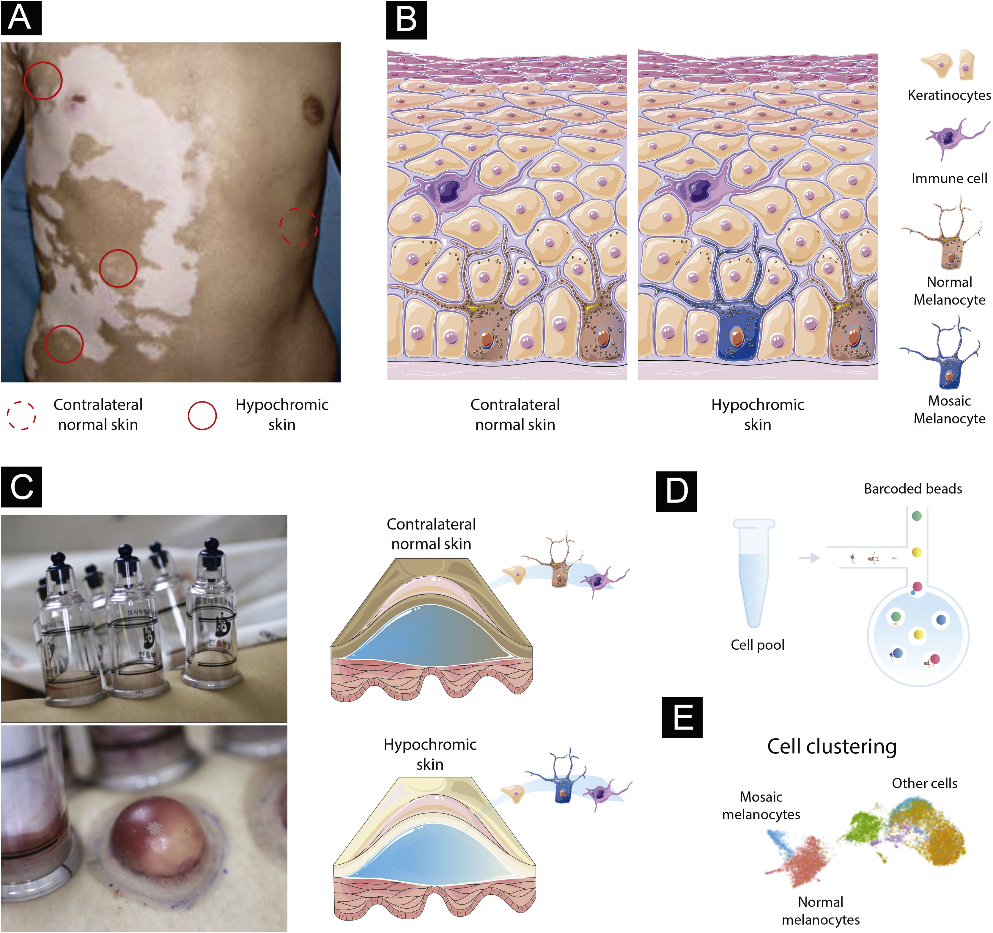Experimental approaches to assess melanocytes mosaicism in segmental ...