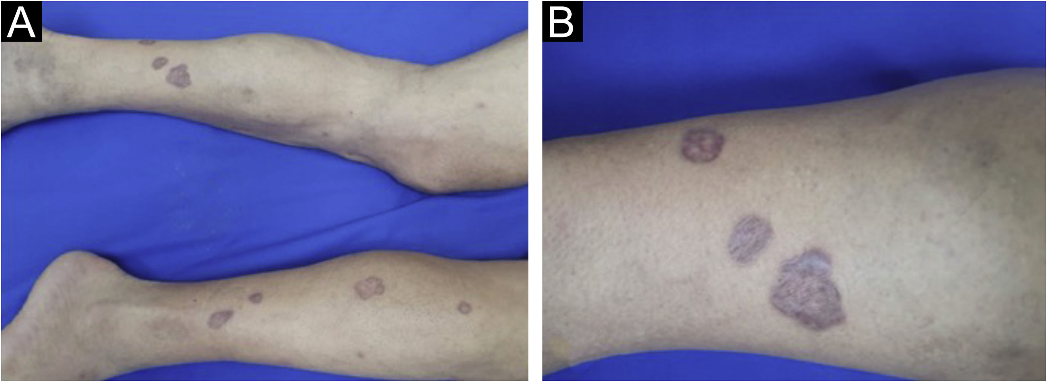Post-COVID-19 lichen planus annularis: report of a rare association ...