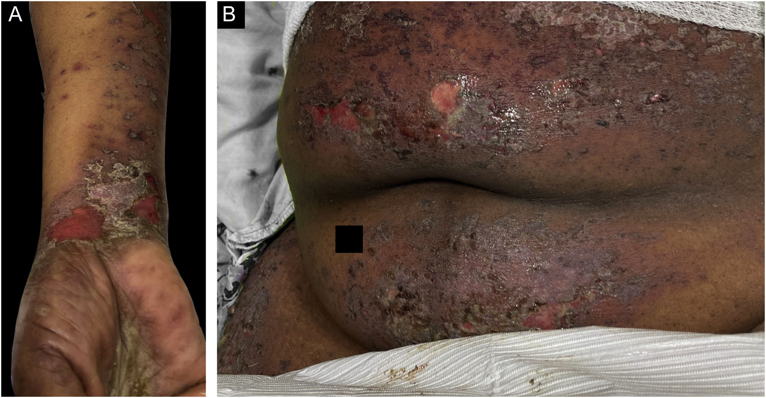 bullous lichen planus code