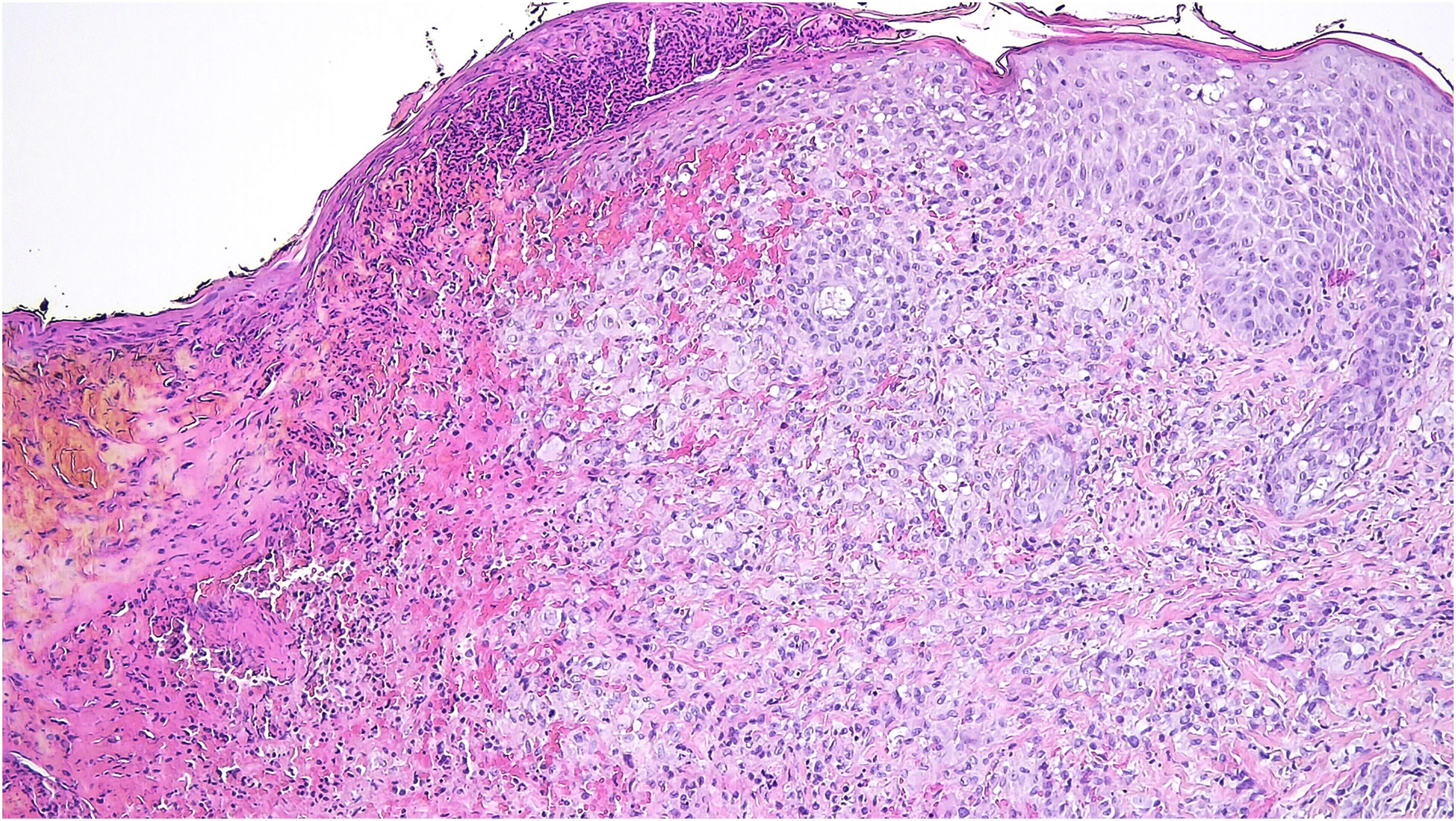 Congenital ulcerated nodule: self-healing Langerhans cell histiocytosis ...