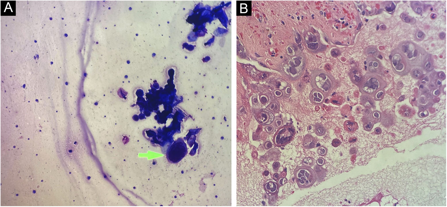 Disseminated varicella with systemic implications in a renal transplant ...