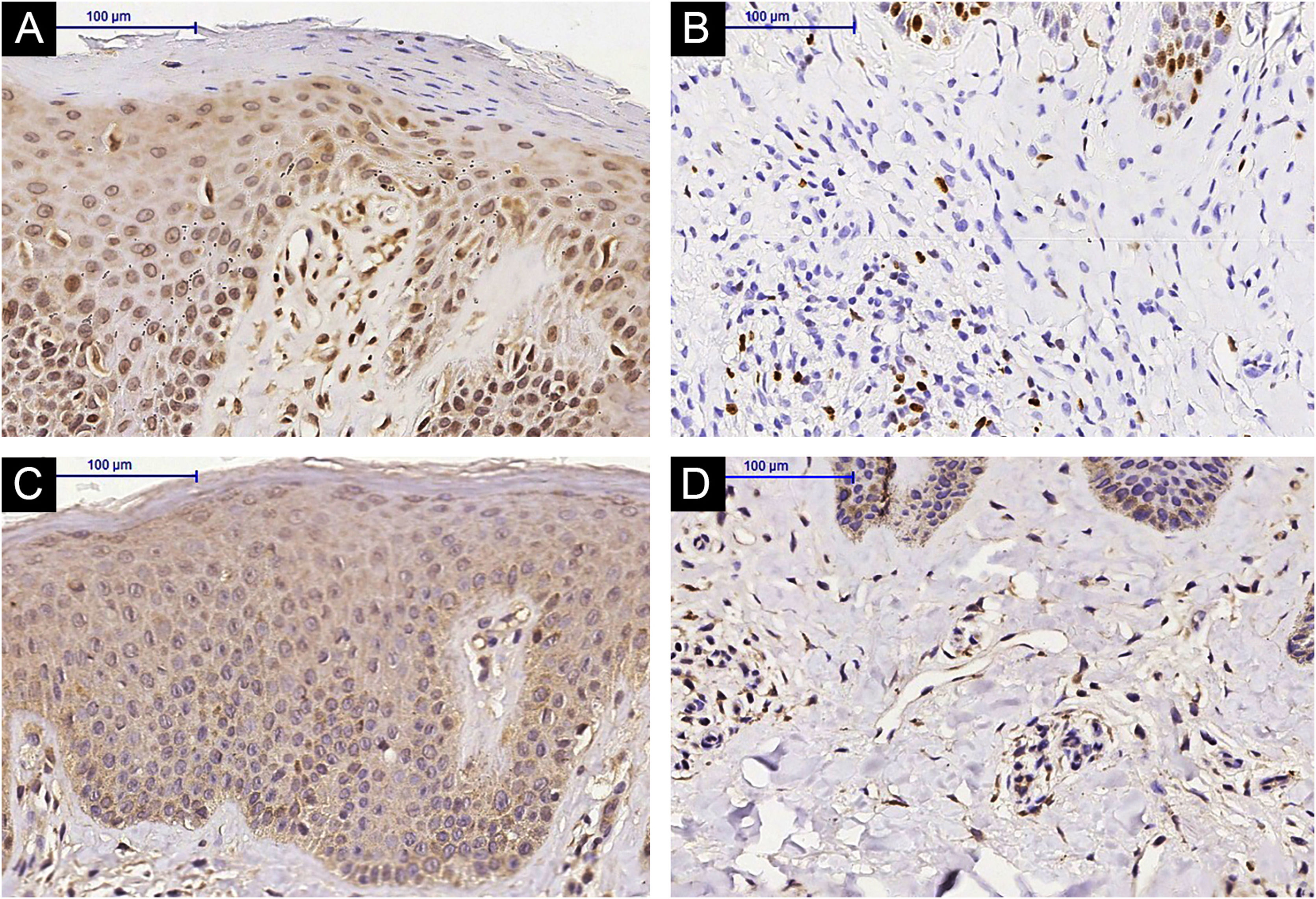 Methotrexate for refractory adult atopic dermatitis leads to ...