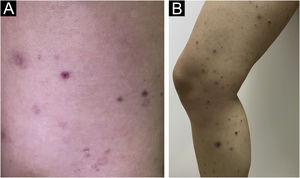 Dermoscopy of pityriasis lichenoides et varioliformis acuta (PLEVA ...
