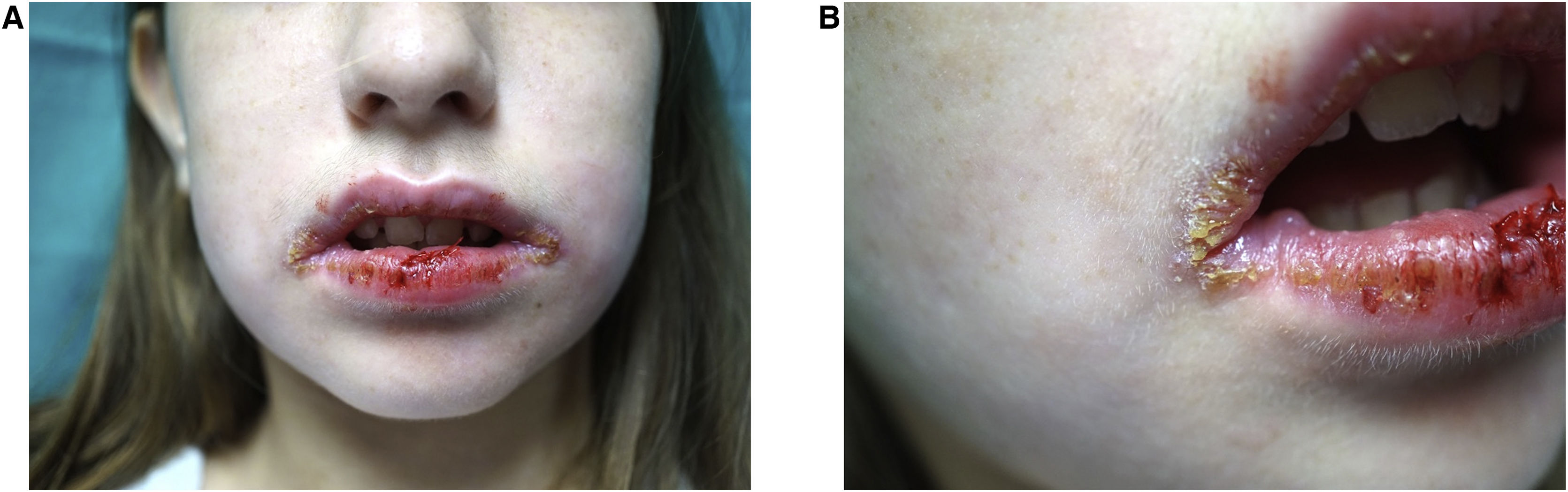 orofacial granulomatosis lips