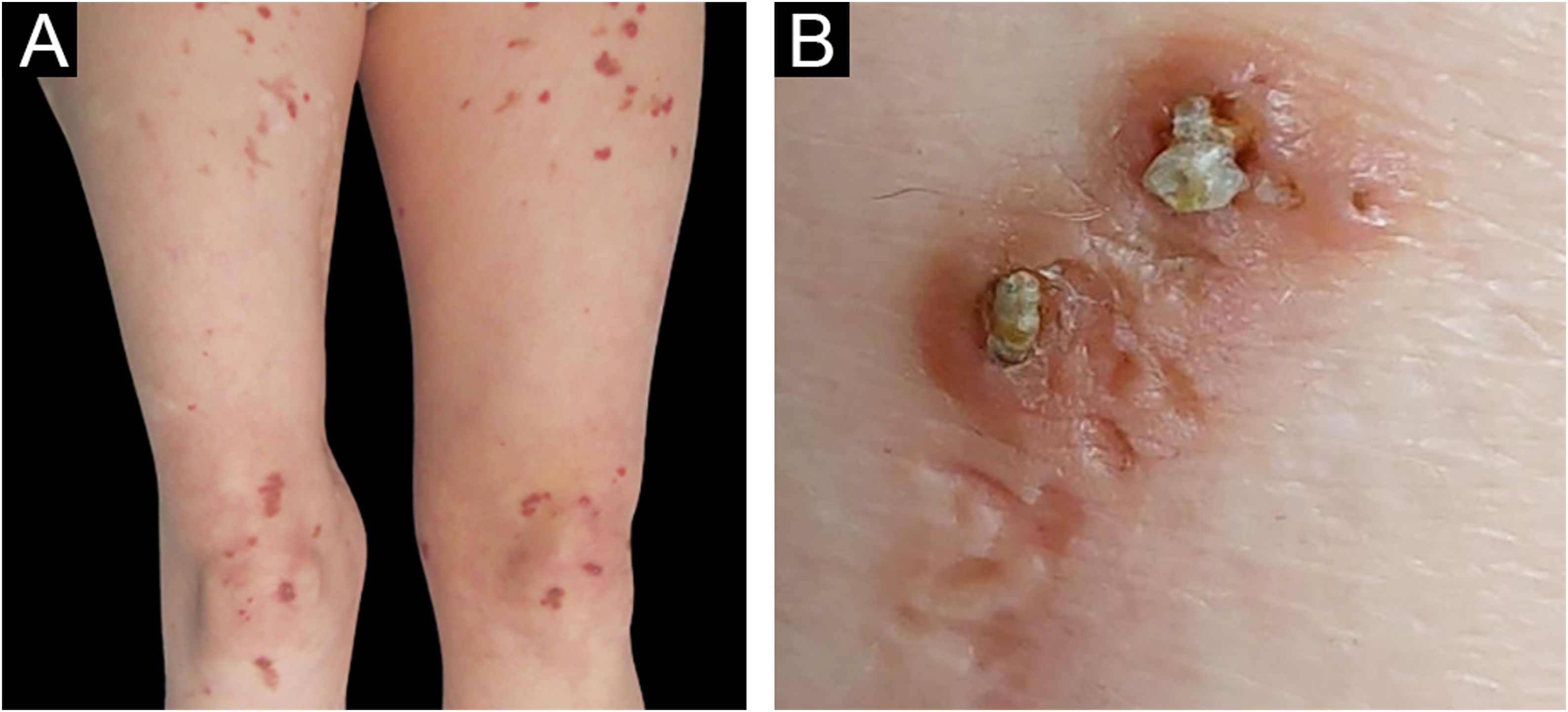 Acquired reactive perforating dermatosis successfully treated with ...